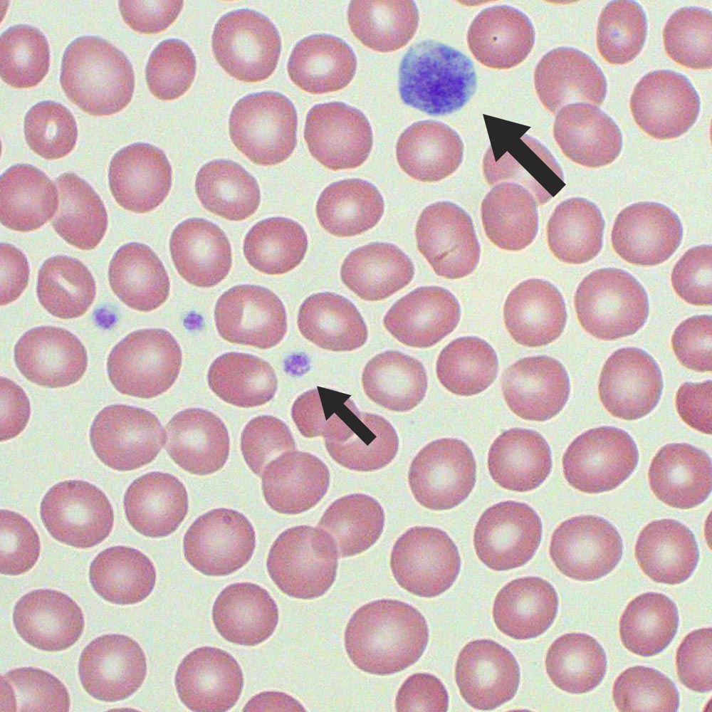 Platelet Morphology Blood Film MedSchool Platelet Morphology Blood Film MedSchool