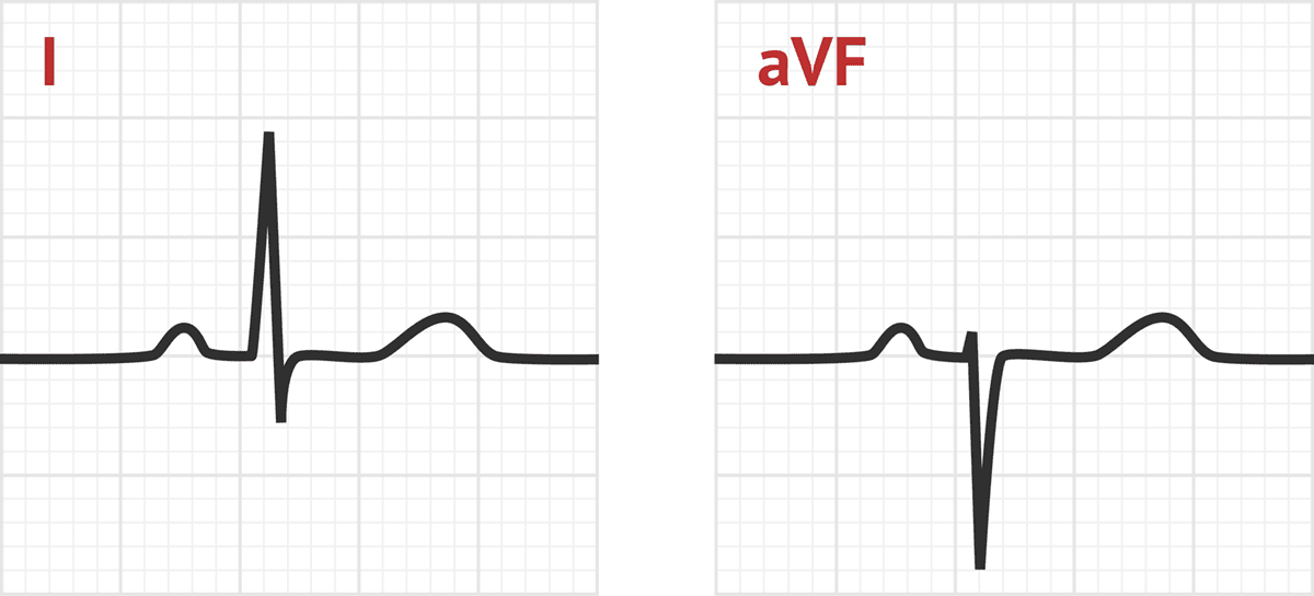 Left Anterior Fascicular Block | Tests - MedSchool
