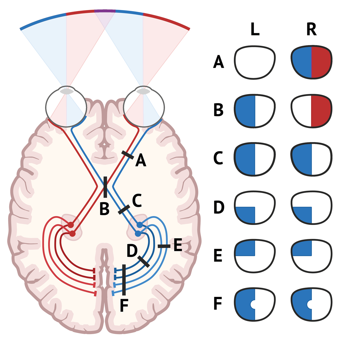 Neurological Visual Field Defect